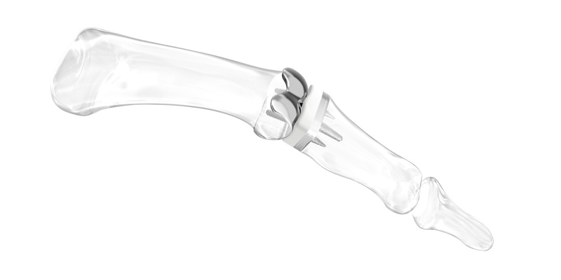 KLS Martin CapFlex PIP - Innovativ protese for det proksimale ...